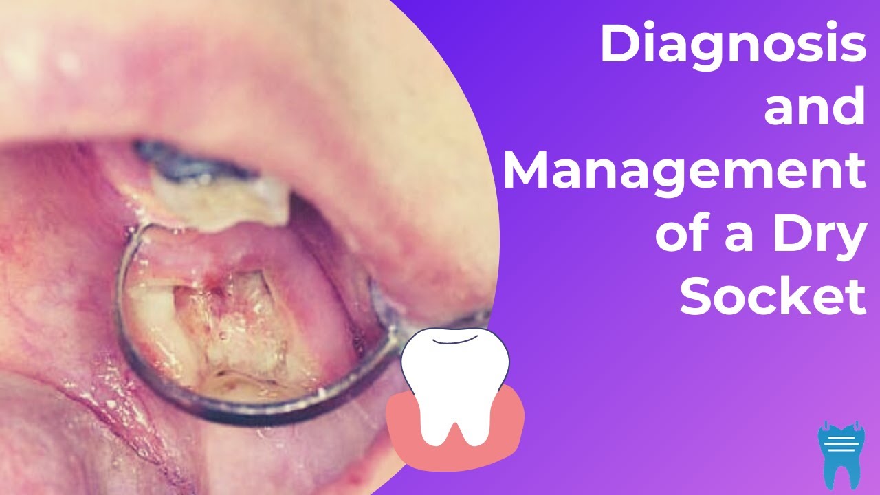 What is a Dry Socket? | Diagnosis and Management