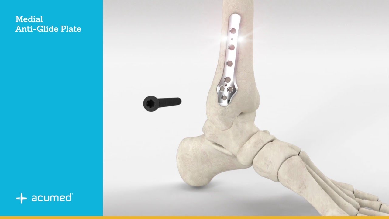 Acumed Ankle Plating System 3