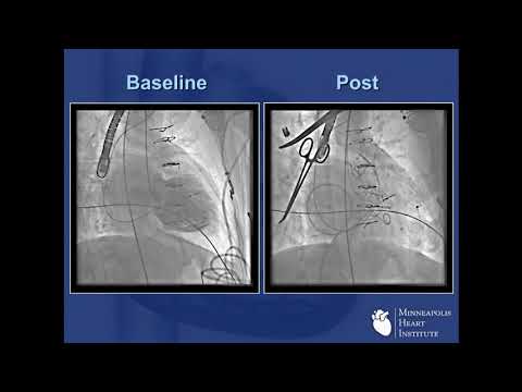 Tendyne Transcatheter MVR: Global Feasibility Results - Paul Sorajja, MD