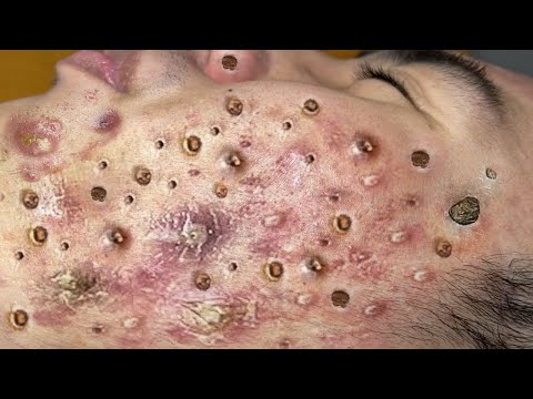 Loan Nguyen Acne Treatment 97x