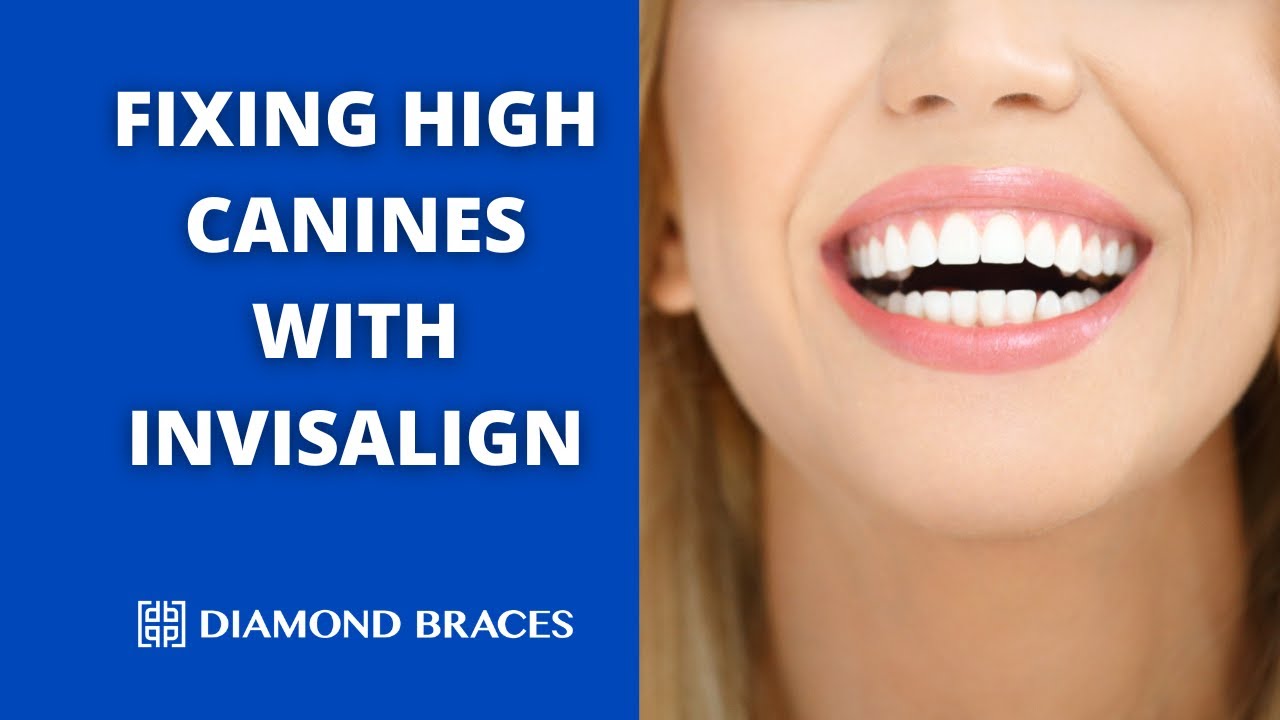 Can Invisalign Fix High Canines