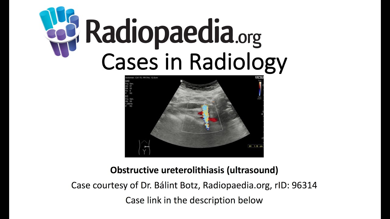 Obstructive ureterolithiasis (ultrasound) (Radiopaedia.org) Cases in Radiology