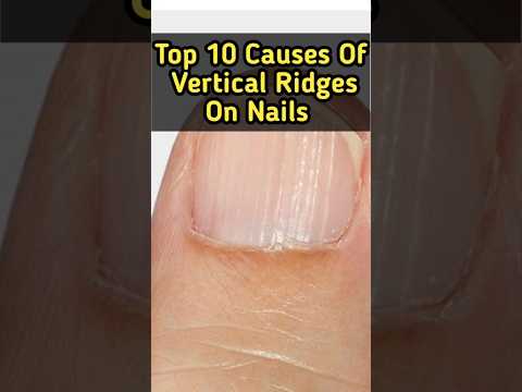 Do you Have vertical ridges on nails??? #shorts #youtubeshorts #top10