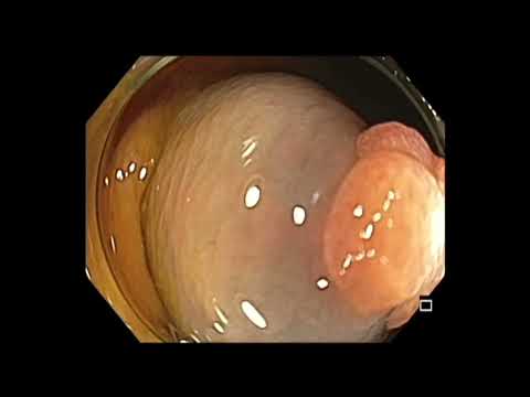 Colon-Colonoscopy-Polyps-Photo documentation of colon polyps