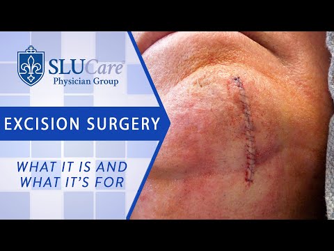 What is Skin Cancer Excision and what you Should Know About It - SLUCare Dermatology