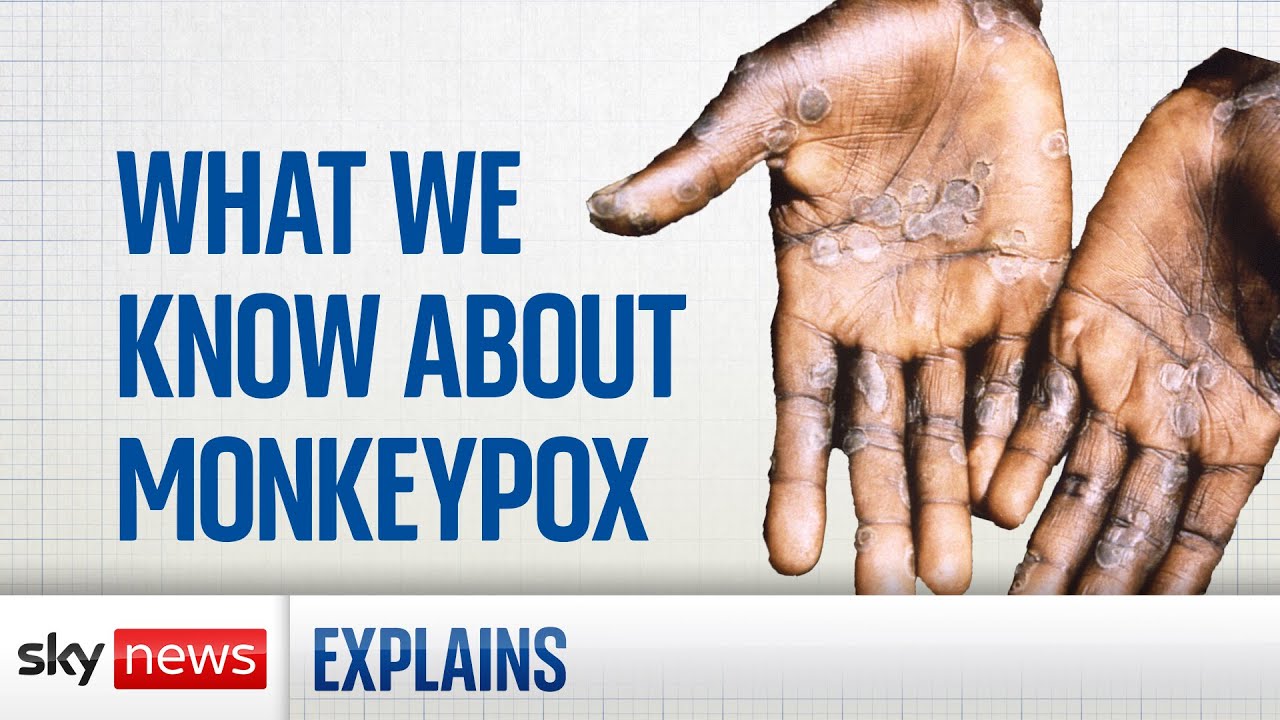Monkeypox: What you need to know