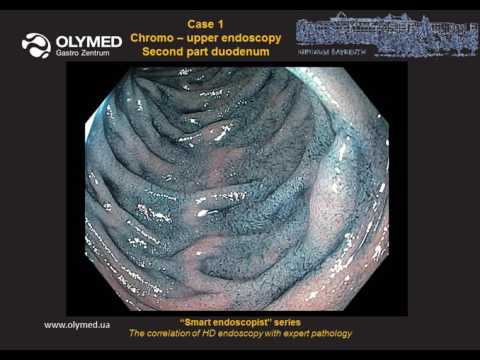 The correlation of HD endoscopy with expert pathology Case 1