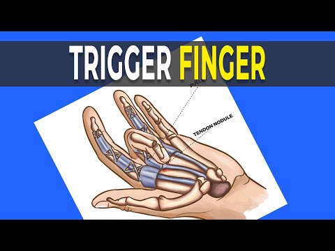 TRIGGER FINGER - WHAT YOU NEED TO KNOW