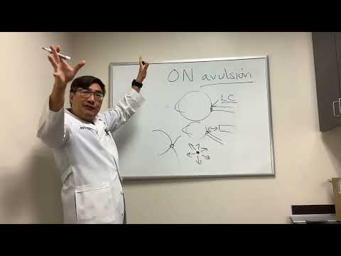 Optic nerve avulsion
