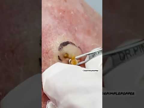 DEEP Dilated Pore of Winer | Dr. Pimple Popper #shorts #drpimplepopper #pimplepopping #pimples