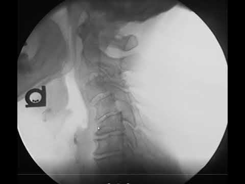 Alar Ligament Test | Centeno-Schultz Clinic