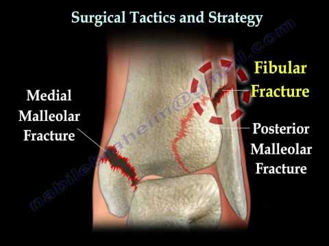 Ankle fracture / Fractures and its repair- Everything You Need To Know - Dr. Nabil Ebraheim