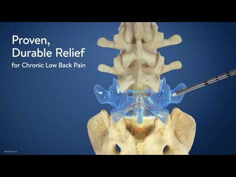 Benefits of Intracept Procedure