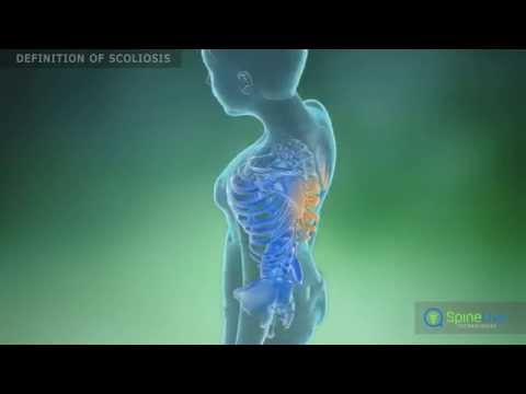 Scoliosis Definition