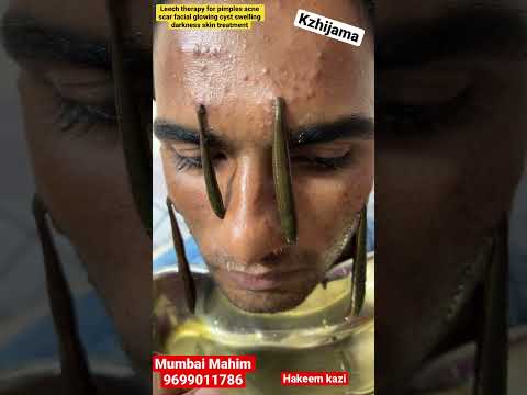Is leech therapy good for face? / #leechtherapy#face#acne#scar#glowingskin#youtube#short#viral