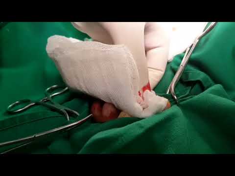 CAULIFLOWER EAR - HEMATOMA AT THE LEFT EAR DRAINAGE