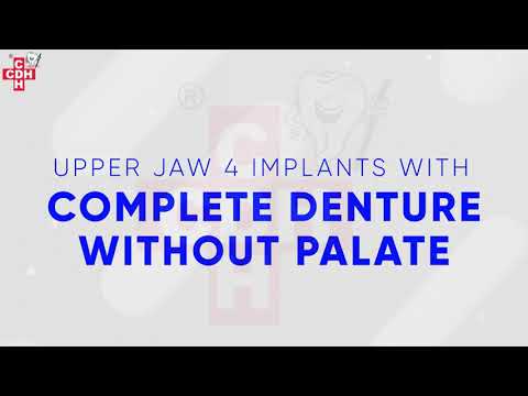 Complete Denture with 4 Implants in Upper Jaw. What is palate less denture?