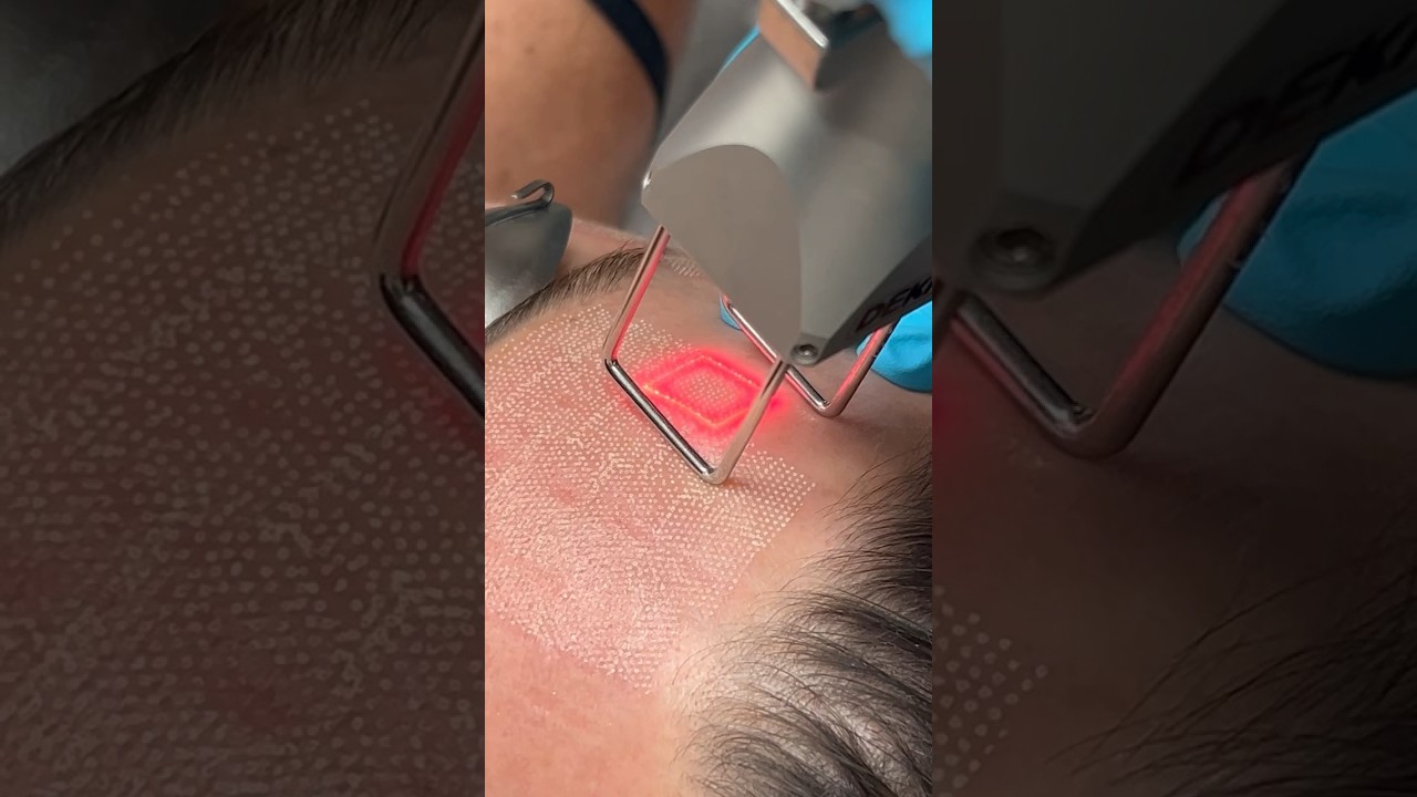 Co2 Resurfacing with #co2 #laser #resurfacing #trending #shorts #reels #viral