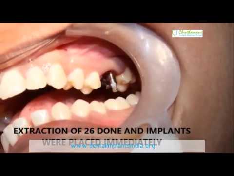 Dental Decay Treatment Chennai | Dental Implants Tamilnadu