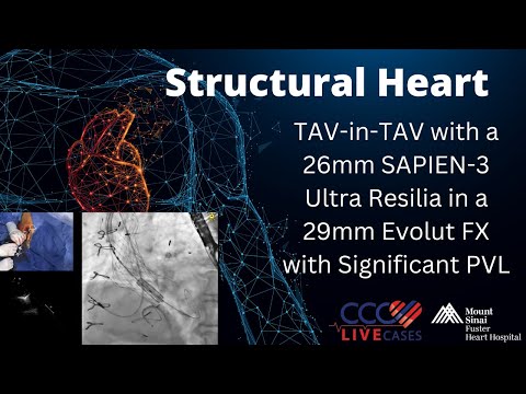 Watch Live TAV-in-TAV with a 26mm SAPIEN-3 Ultra Resilia in a 29mm Evolut FX with Significant PVL