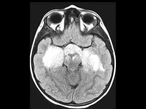 Optic Pathway Glioma