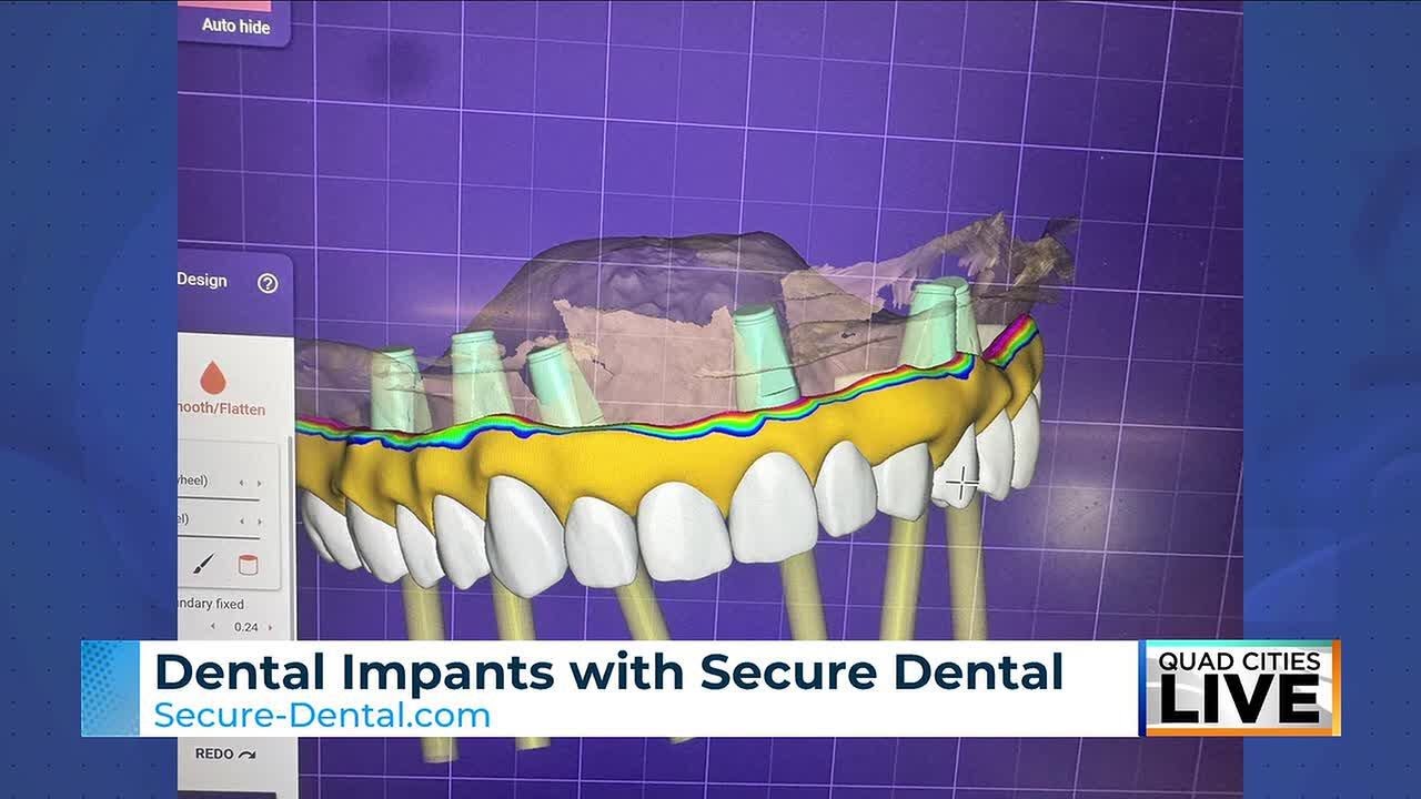Dental implants explained: Secure Dental shares key facts for missing‑tooth solutions