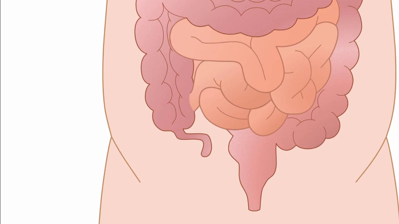 What is Laparoscopic Appendectomy?