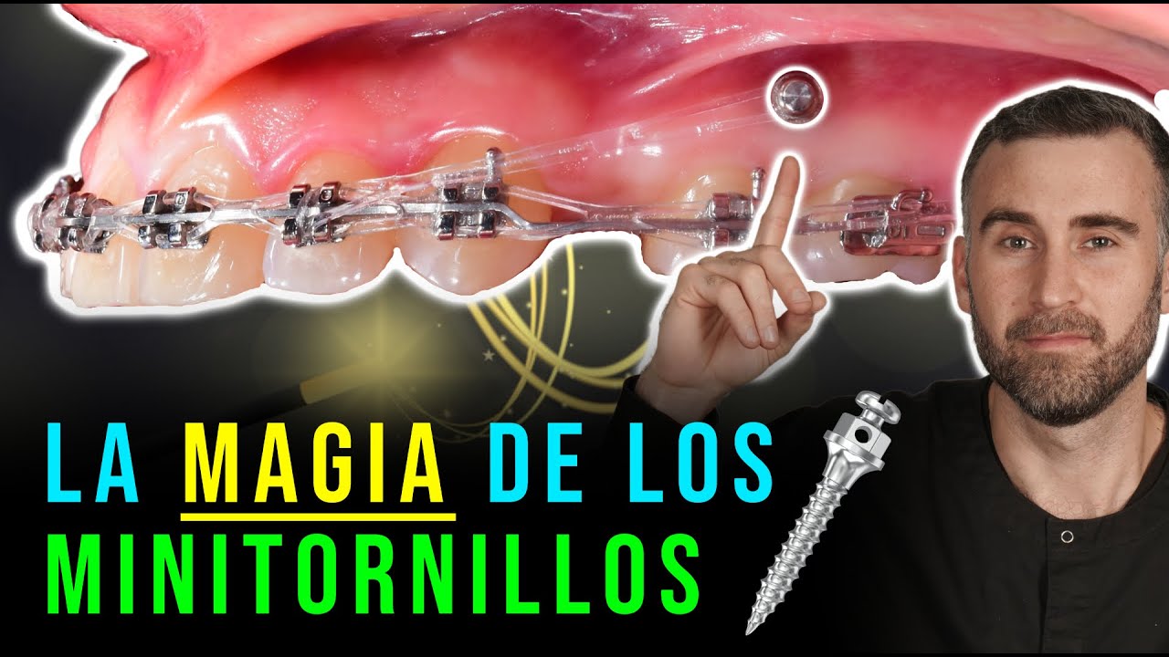 MINITORNILLOS en Ortodoncia 🔩 ¿Qué son? ¿Para qué sirven?