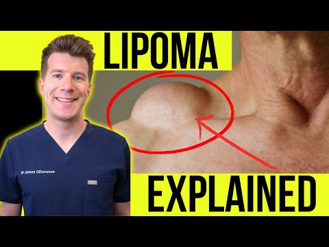 Doctor explains LIPOMA | Symptoms, clinical photos and treatment