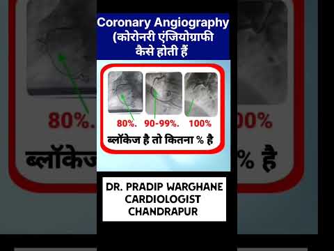 #cardiaccatheterization #angiogram # cardiologist