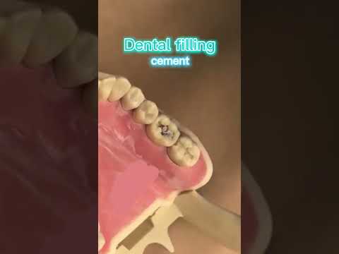 DENTAL FILLING - MEDICAL DEFINITION | Medical Consecutive Interpreting