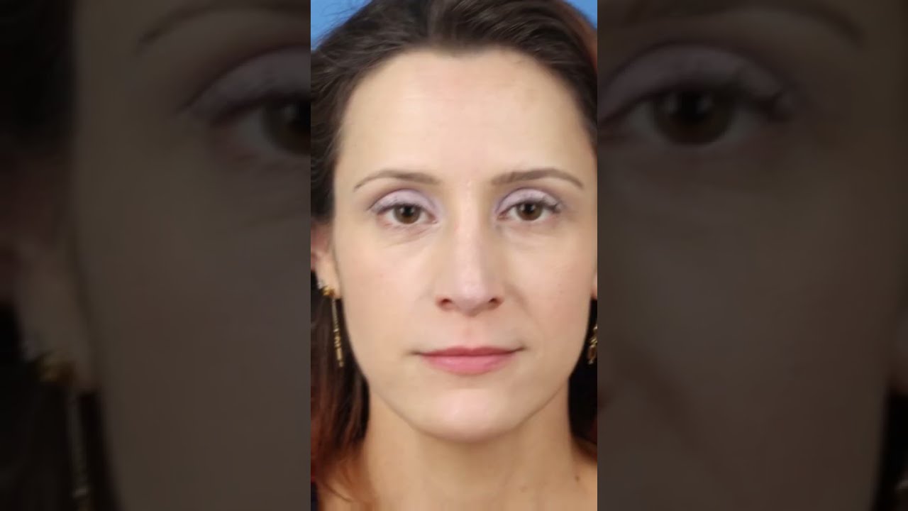 Septoplasty Before and After: Correcting Very Deviated Septum