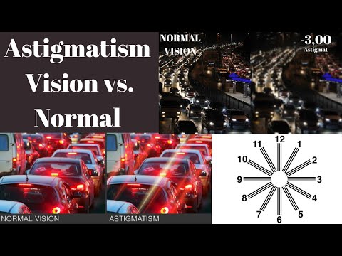 Astigmatism Vision vs normal, Astigmatism Symptoms, What is astigmatism