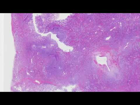 Kaposi Sarcoma