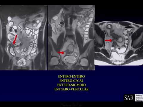 Interpreting CTE/MRE in Crohn's Disease-- Mark Baker, MD (SCBT-MR/SABI 39th Annual Course)