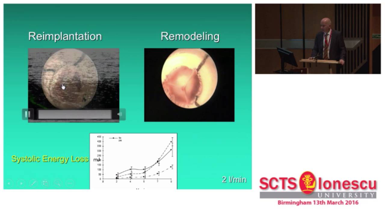 Valve sparing aortic root surgery