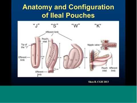 HealthPROMISE Webinar Series: Pouchitis and IBD - October 2016
