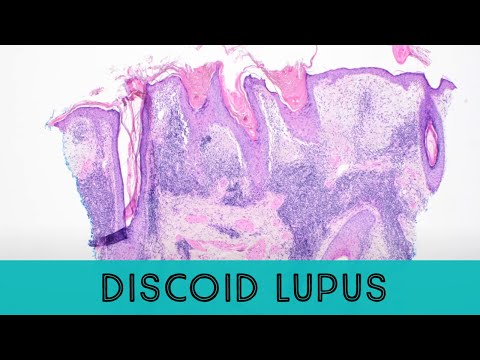 Discoid Lupus Erythematosus under the microscope (pathology dermatology dermpath)