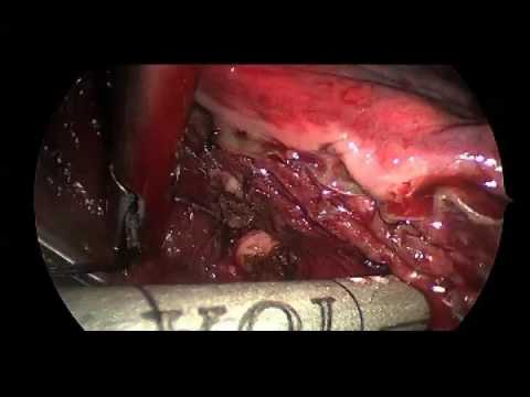 3D Reconstruction for Atpical Resection of Growing Hamartoma