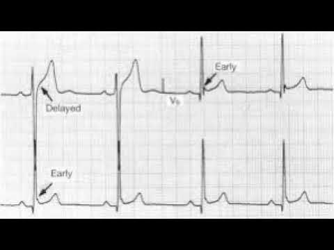 Podcast 846: Early Repolarization vs. Anterior STEMI