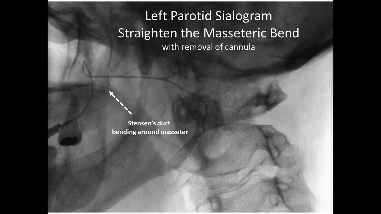 sialogram straighten stensens duct around masseter  11152021