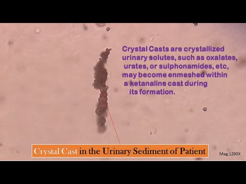 Crystal Casts in Urine: Introduction, Visualization and Clinical Singificance