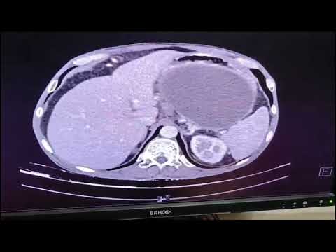 Laparoscopic Management of a Large Pancreatic Pseudocyst - Dr. Rajesh Patil