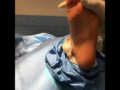 Foot mass / plantar fibromatosis