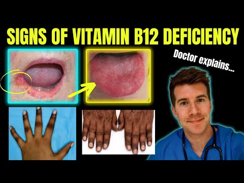 Doctor explains clinical signs of Vitamin B12 (cobalamin) deficiency | Glossitis, mouth ulcers etc.