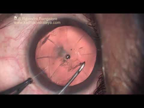 Phaco Training: MS Sir Performs Phacosection SICS on a High Myopic Eye ...