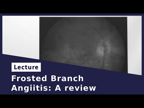 Frosted Branch Angiitis: A review