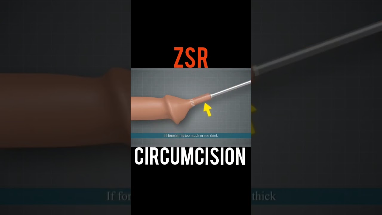 ZSR Circumcision  #viral