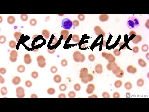 Rouleaux Formation: Erythrocytes on Peripheral Blood Smear in Multiple Myeloma (Hemepath Hematology)