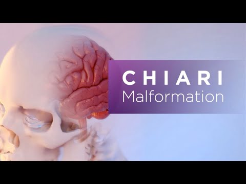 Chiari Malformation